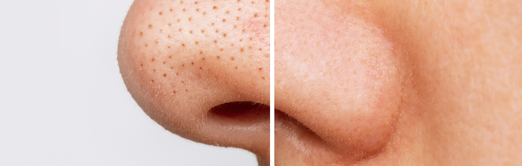 Cum poti scapa de punctele negre sau de comedoane | CeraVe